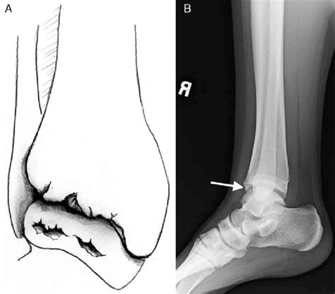 Osteophyte Formation From Trauma