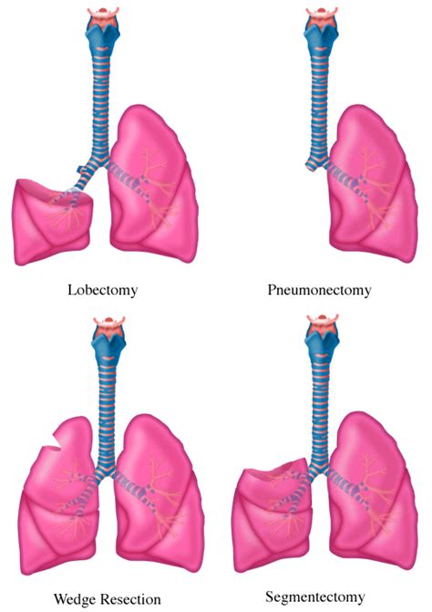 Lung Surgeries Cardiothoracic Critical Care Nursing Education