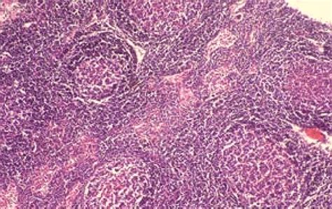 Reactive Hyperplasia Of Lymph Node In Cortex Follicles Are Increased Download Scientific