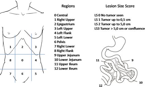 Peritoneal Cancer Index Pci By Sugarbaker Download Scientific Diagram Peritoneal Cancer Index Pci By Sugarbaker Download Scientific Diagram