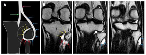 Ganglion Cyst Proximal Tibiofibular Articulation
