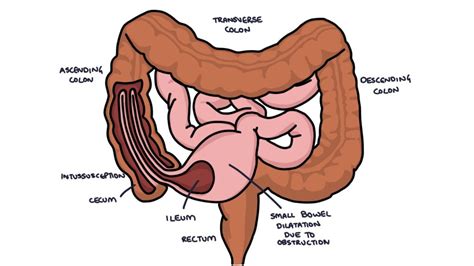 Intussusception Zero To Finals