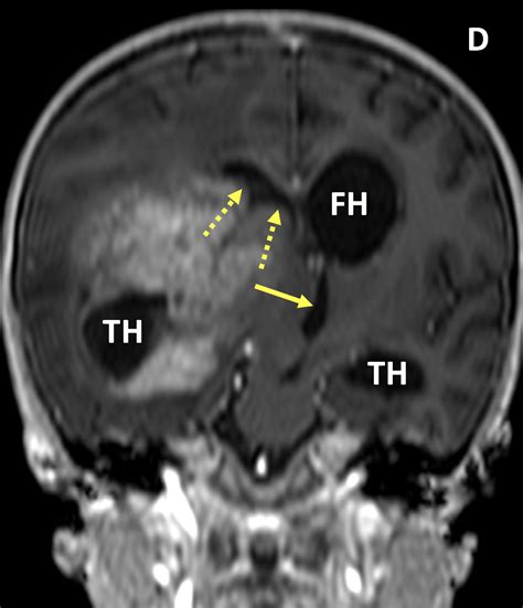 Hydrocephalus Mri Online Medality