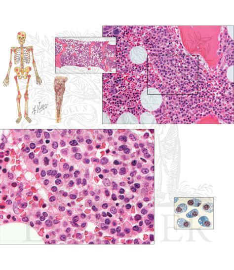 Pathology Of Blood And Bone Marrow