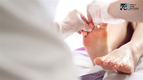 Cellulitis Infection Foot