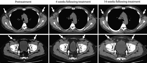 Marked Reduction Of Peripheral Lymphadenopathy Was Observed After