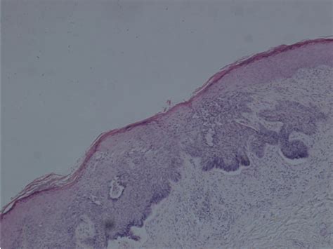 Solid Nodular BCC 52 Years Old Male X40 Download Scientific Diagram