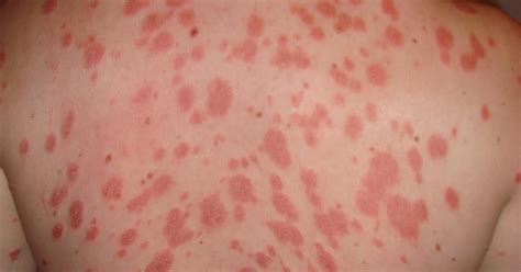 La Que Sigue Aquí Psoriasis Guttata Espalda