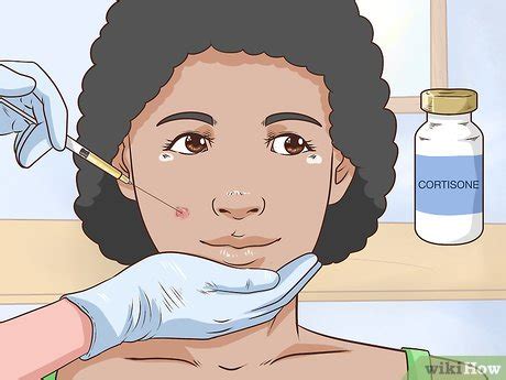 Ways To Painlessly Pop A Pimple WikiHow