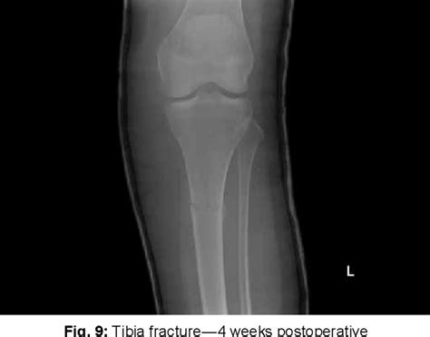 Figure 1 From Proximal Medial Tibial Bone Graft Harvesting In Foot And