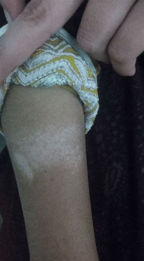Hypopigmented Lesion On The Elbow Download Scientific Diagram
