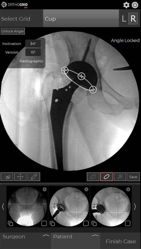 “orthogrid Hips Ability To Correct Fluoroscopic Distortion Is Critical
