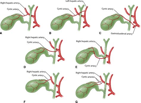Cystic Artery