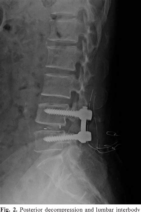 Figure 1 From Treatment For The Lumbosacral Soft Tissue Defect After Spine Surgery Semantic