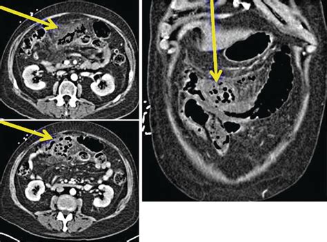 Abdominal Sepsis And Complicated Intraabdominal Infections Anesthesia Key
