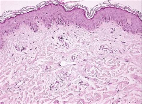 Examination Of A Lesion Using A Stain For Elastic Tissue Shows That In Examination Of A Lesion Using A Stain For Elastic Tissue Shows That In