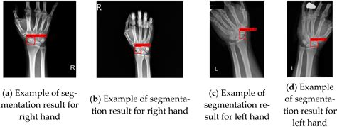 Left Scaphoid Fracture