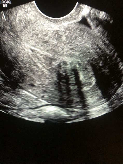 Submucosal Fibroid Or Something Else Came Across This Today And I Have Never Seen Something