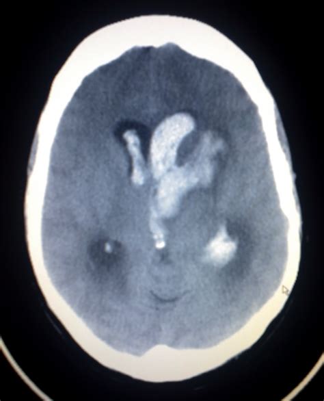 Intracerebral Hemorrhage Concise Medical Knowledge