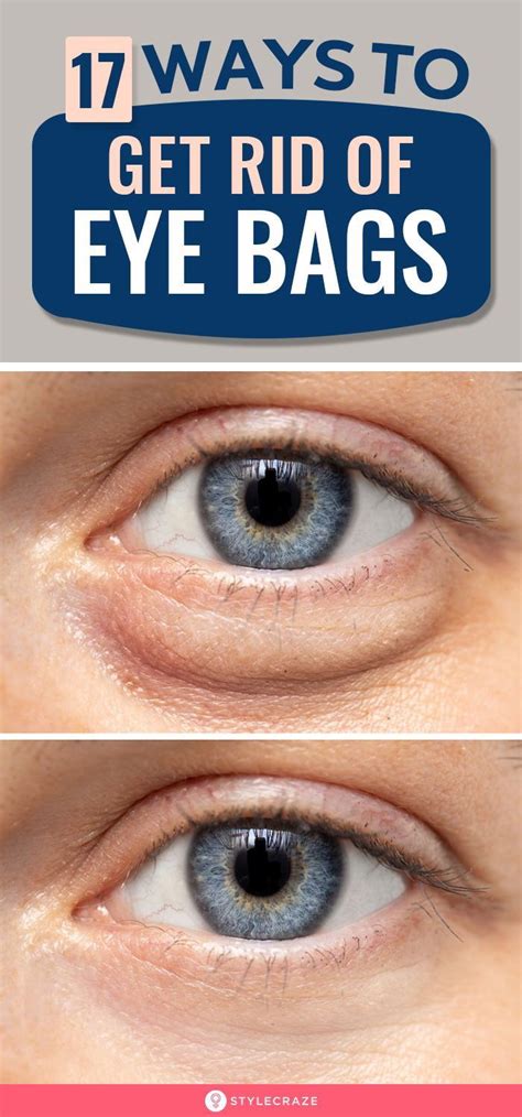 Allergy Medicine For Bags Under Eyes At Anthony Monroy Blog