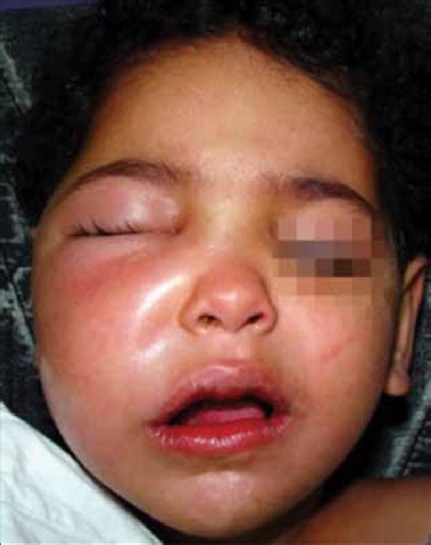 Large Right Facial Swelling Due To Upper 5th Tooth Infection