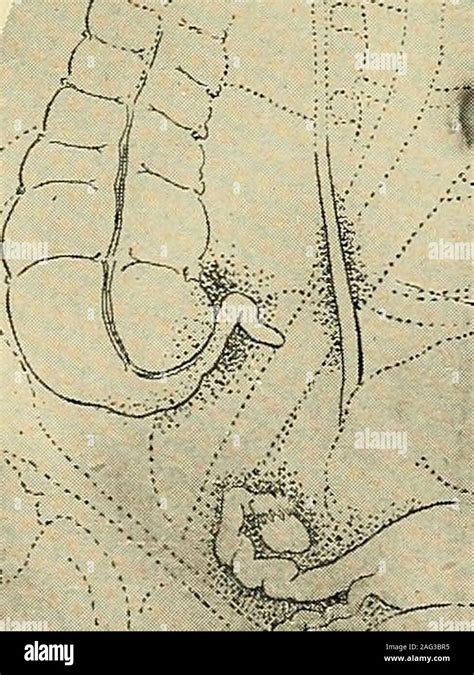 Fluid In Abdomen Hi Res Stock Photography And Images Alamy