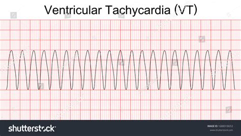 Polymorphic Ventricular Tachycardia Ecg Polymorphic Ventricular Tachycardia Ecg