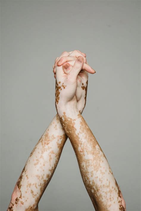 Are Leukoderma And Vitiligo Different