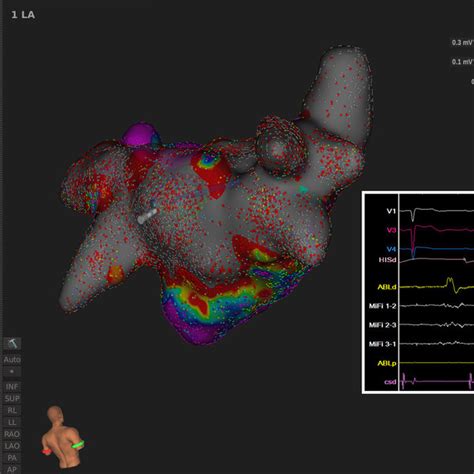 A Patient Who Had Undergone A Box Posterior Wall Isolation And Download Scientific Diagram