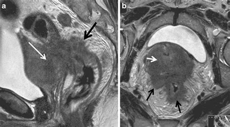 Cervical Cancer Stage Iva With Rectal Invasion A Sagittal And B