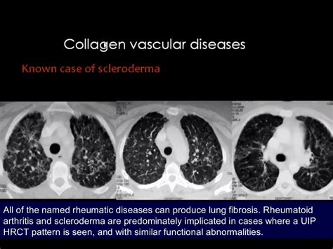 Hrct Reticular Pattern