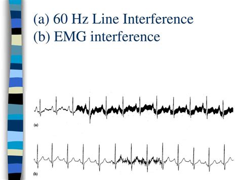 Ppt Ecg Signal Make Up Powerpoint Presentation Free Download Id