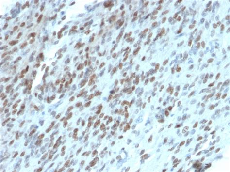 Tle1 Synovial Sarcoma Marker Antibody Clone Tle12062 Gene Id 7088