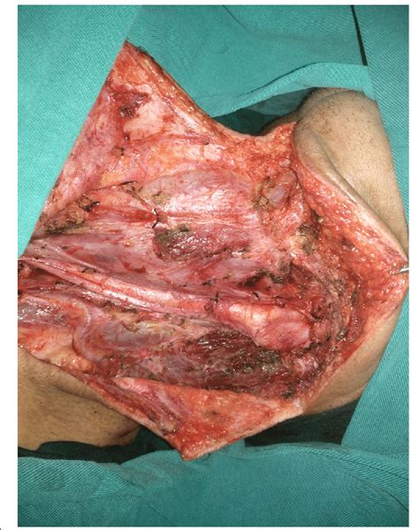 Radical Neck Dissection For Salvage Surgery Download Scientific Diagram