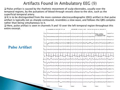 Artifact Removal From Ambulatory Eeg Pptx