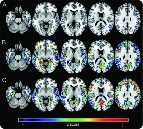 Sex Differences In Alzheimer Risk Brain Imaging Of Endocrine Vs