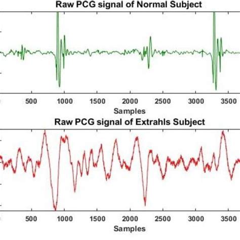 Waveform Of The Existing Cvd Classes On Pcg Dataset A Aortic Download Scientific Diagram