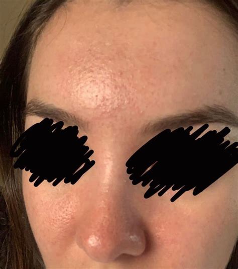 Forehead Bumps Rrosacea