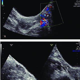 Ultrasonographic Image Showing Inhomogenous Echoes In The Vagina A B Download Scientific
