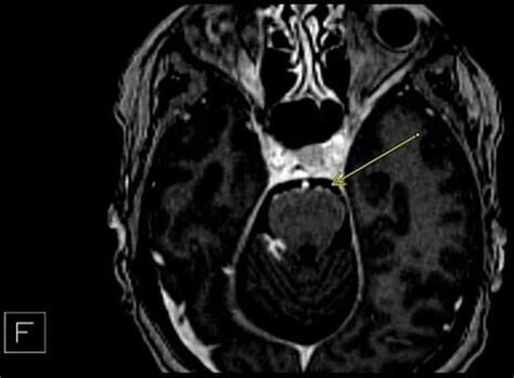 Systemic Absorption Of Intrathecal Methotrexate Pmc