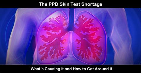 The National PPD Skin Test Shortage What S Causing It And How To Get Around It National