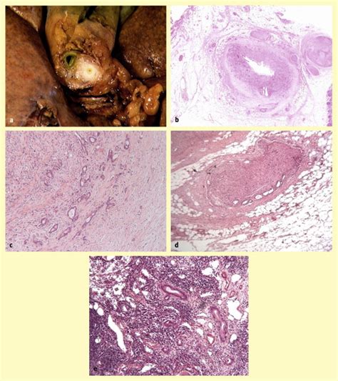 Cholangiocarcinoma New Concepts And Classifications Diagnostic