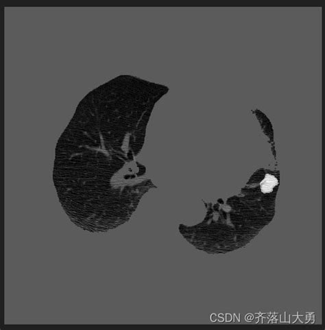 基于opencv对胸部ct图像的预处理 ct bone artifact opencv csdn博客