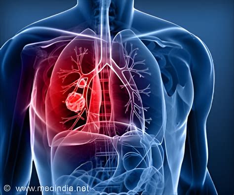 Hmpv Infection Can Cause Flu Like Symptoms