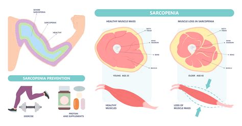 Sarcopenia Symptoms Causes Risk Factors And Treatment