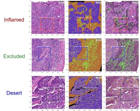 Lunit Presents Ai Powered Pathologic Classification Of Immune Phenotype