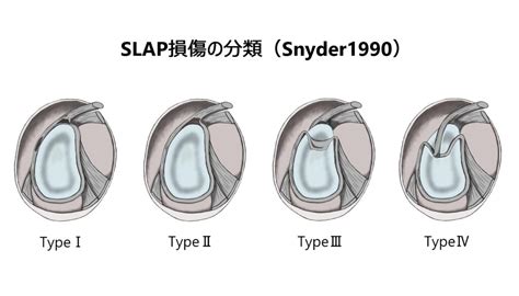 肩関節脱臼（dislocation Of Shoulder）