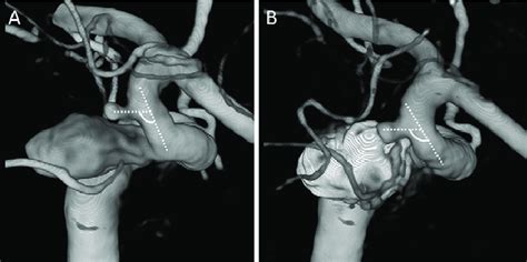 Three Dimensional Dsa 3d Dsa Of The Left Ica A Preoperative Image Download Scientific