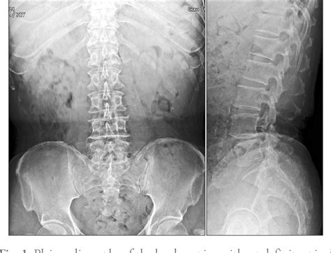 Figure 1 From Radiological Anatomical Consideration Of Conjoined Nerve
