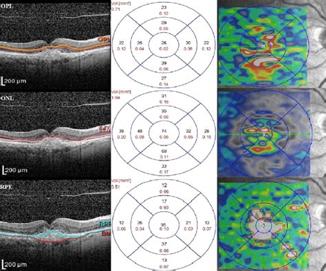 Representation Of Intraretinal Layer Segmentation And Average Volume Download Scientific